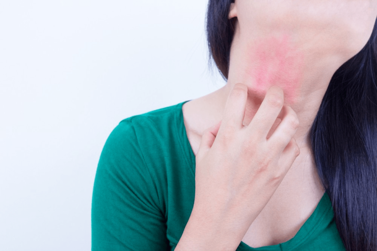 Allergic Reactions: How Do They Happen? | Makati Med