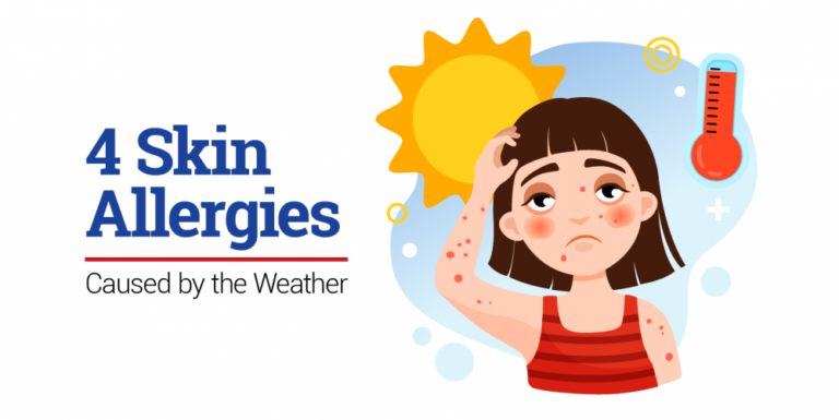 4 Skin Allergies Caused by the Weather | Makati Med