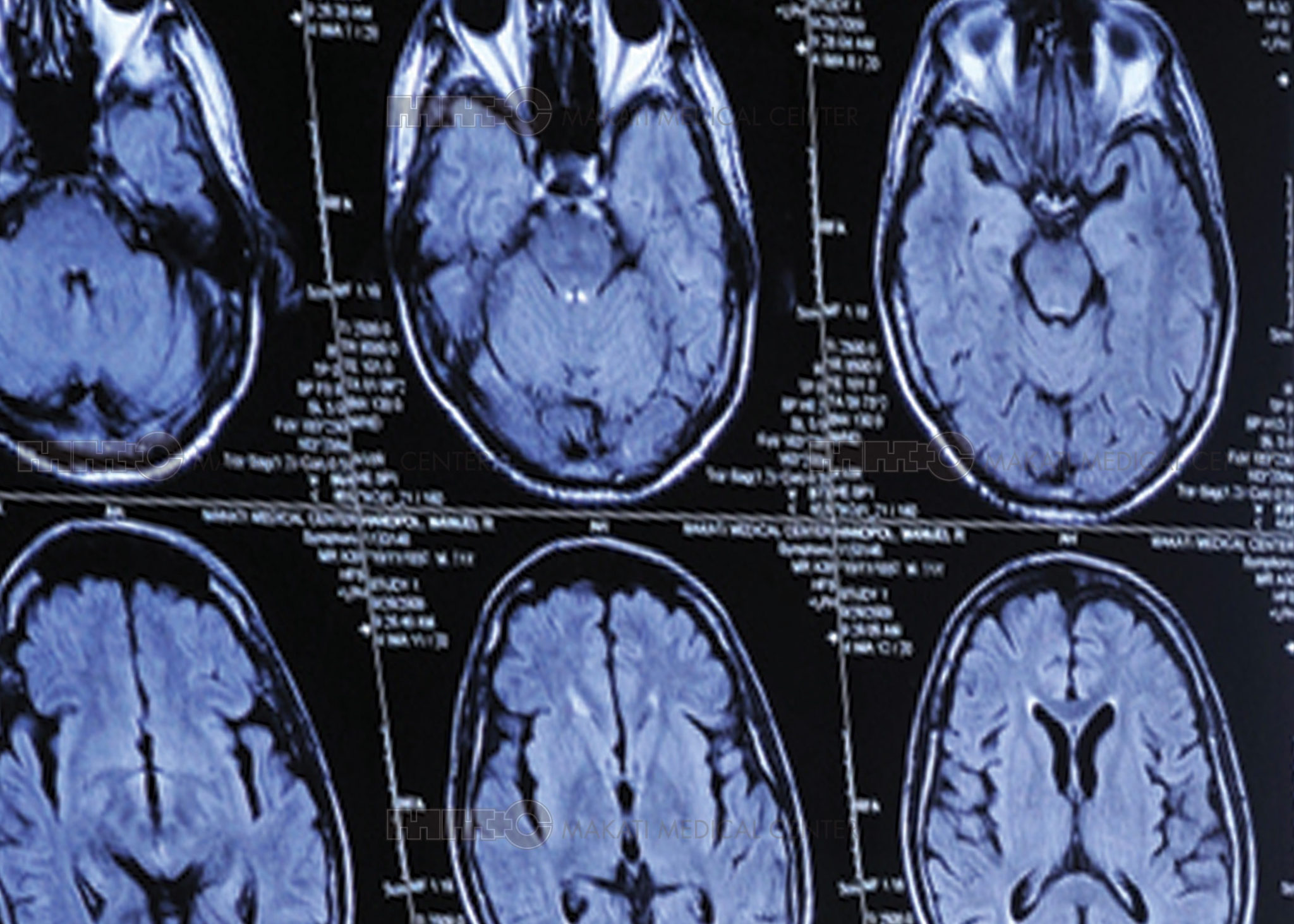 Neuropsychological Disorders - Makati Medical Center