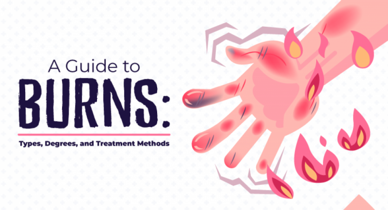 Guide to Types, Degrees, & Treatment For Burns | Makati Med