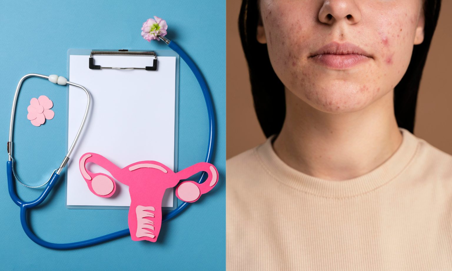 PCOS in the Philippines: A Guide to Living with PCOS