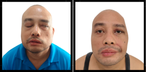 MakatiMed's First Facial Reanimation Surgery Milestone